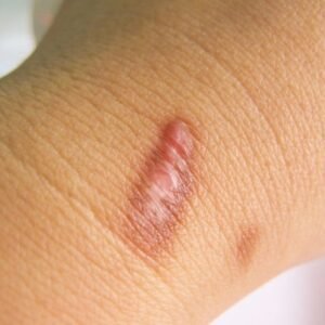 Dealing With Acne Scars? Let's Have Remedies And Treatments